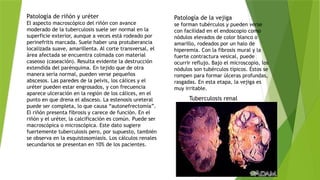 Tuberculosis Renal, vesical, ureteral.pptx