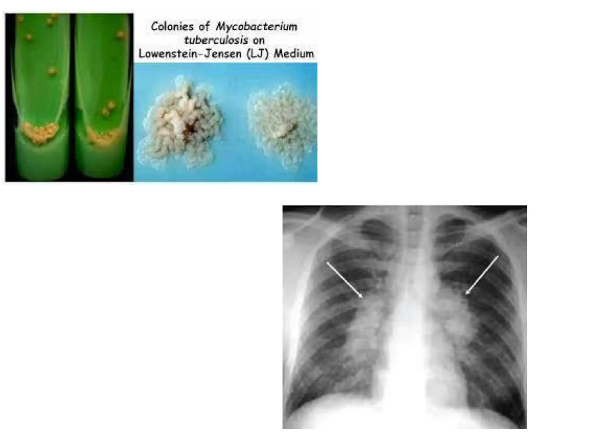 Tuberculosis (TB)-Notes.pdf microbiology notes | PDF
