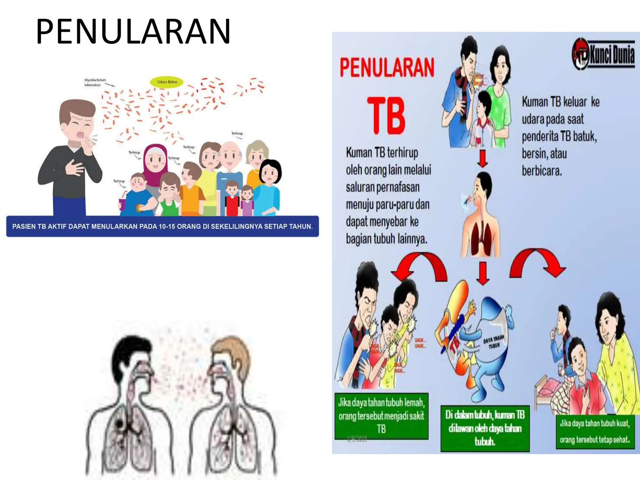 FedraagathamateriTUBERCULOSIS (TBC).pptx