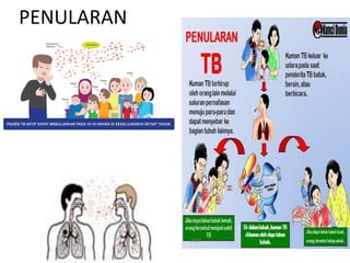 FedraagathamateriTUBERCULOSIS (TBC).pptx