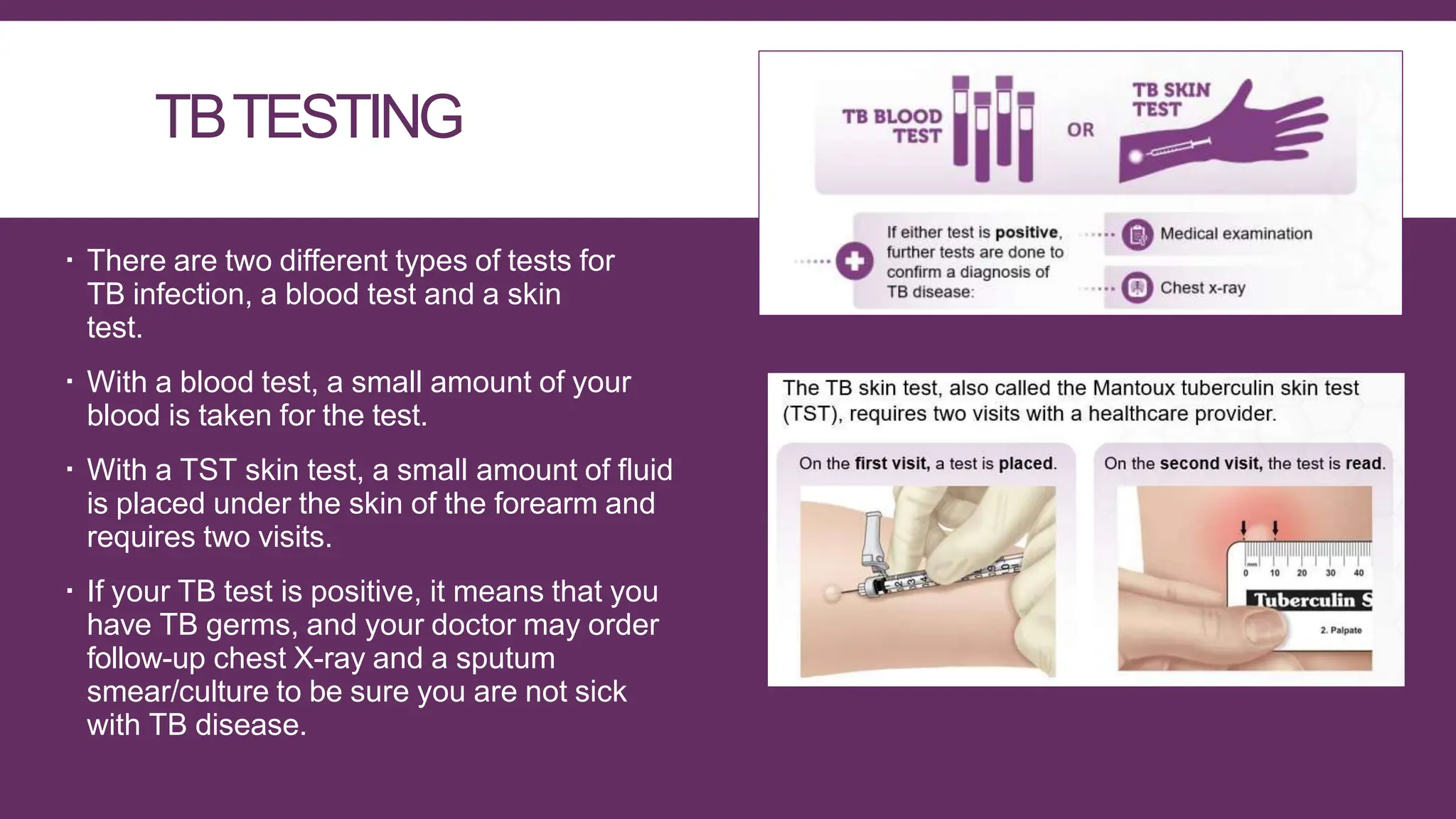 Tuberculosis (T. B) Presentation . pptx | PPT