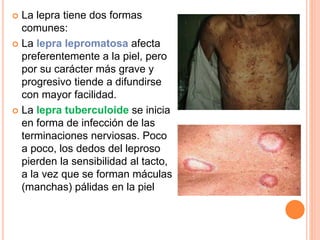 Tuberculosis y lepra | PPTX