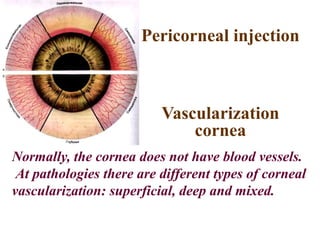 Tuberculous and syphilitic keratitis.pptx