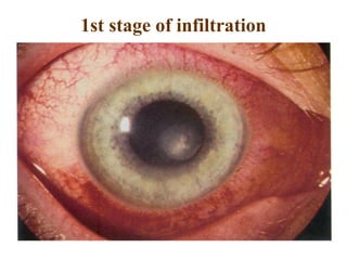 Tuberculous and syphilitic keratitis.pptx