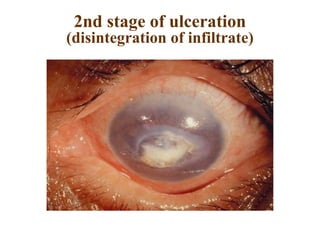 Tuberculous and syphilitic keratitis.pptx