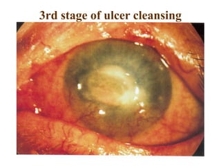 Tuberculous and syphilitic keratitis.pptx