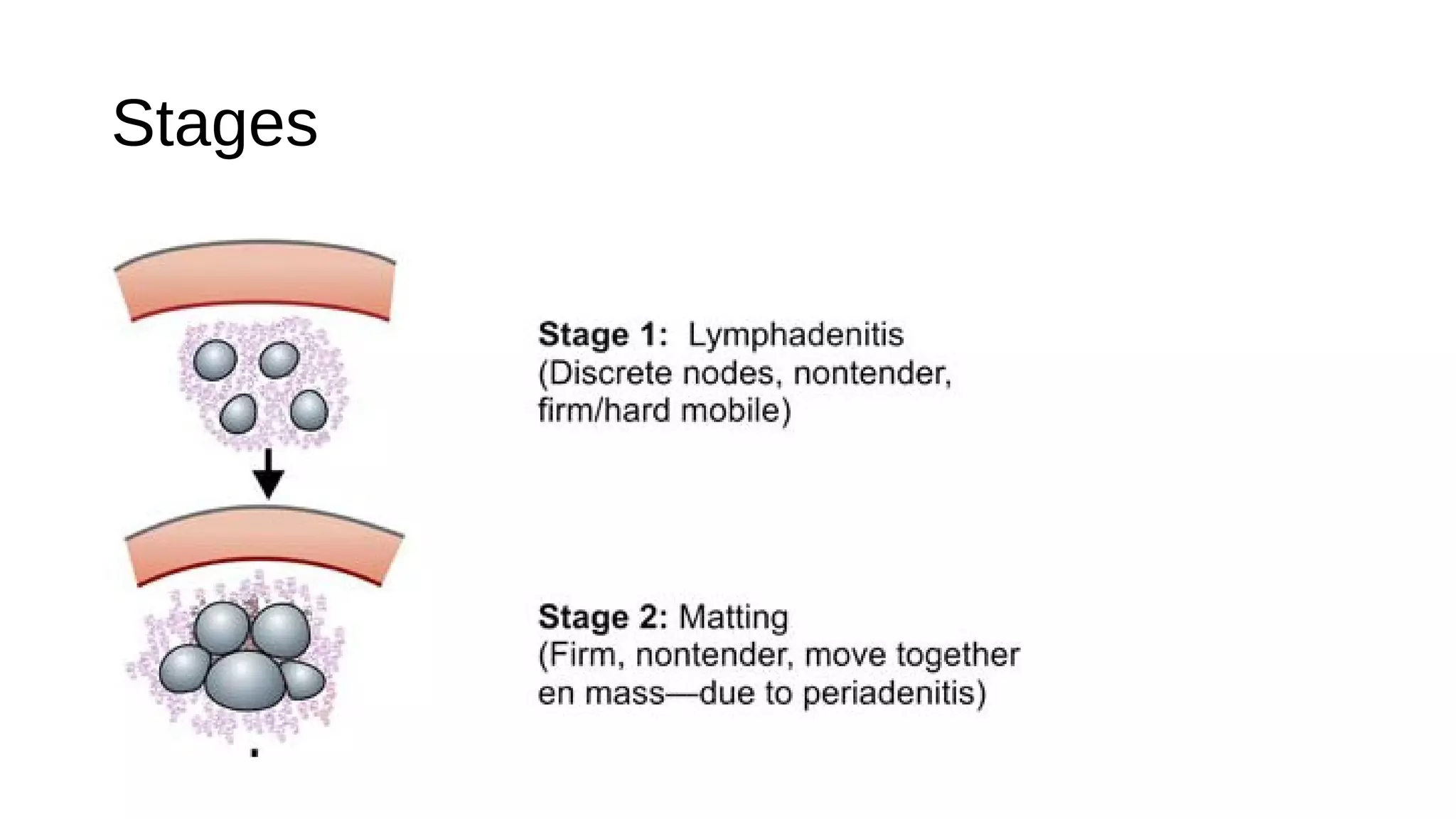Tuberculous cervical lymphadinitis | PPT