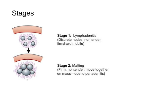 Tuberculous cervical lymphadinitis | PPT | Ear, Nose and Throat ...