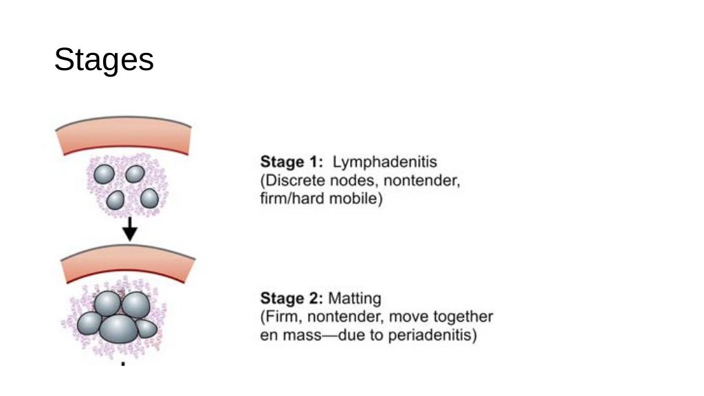 Tuberculous Cervical Lymphadinitis