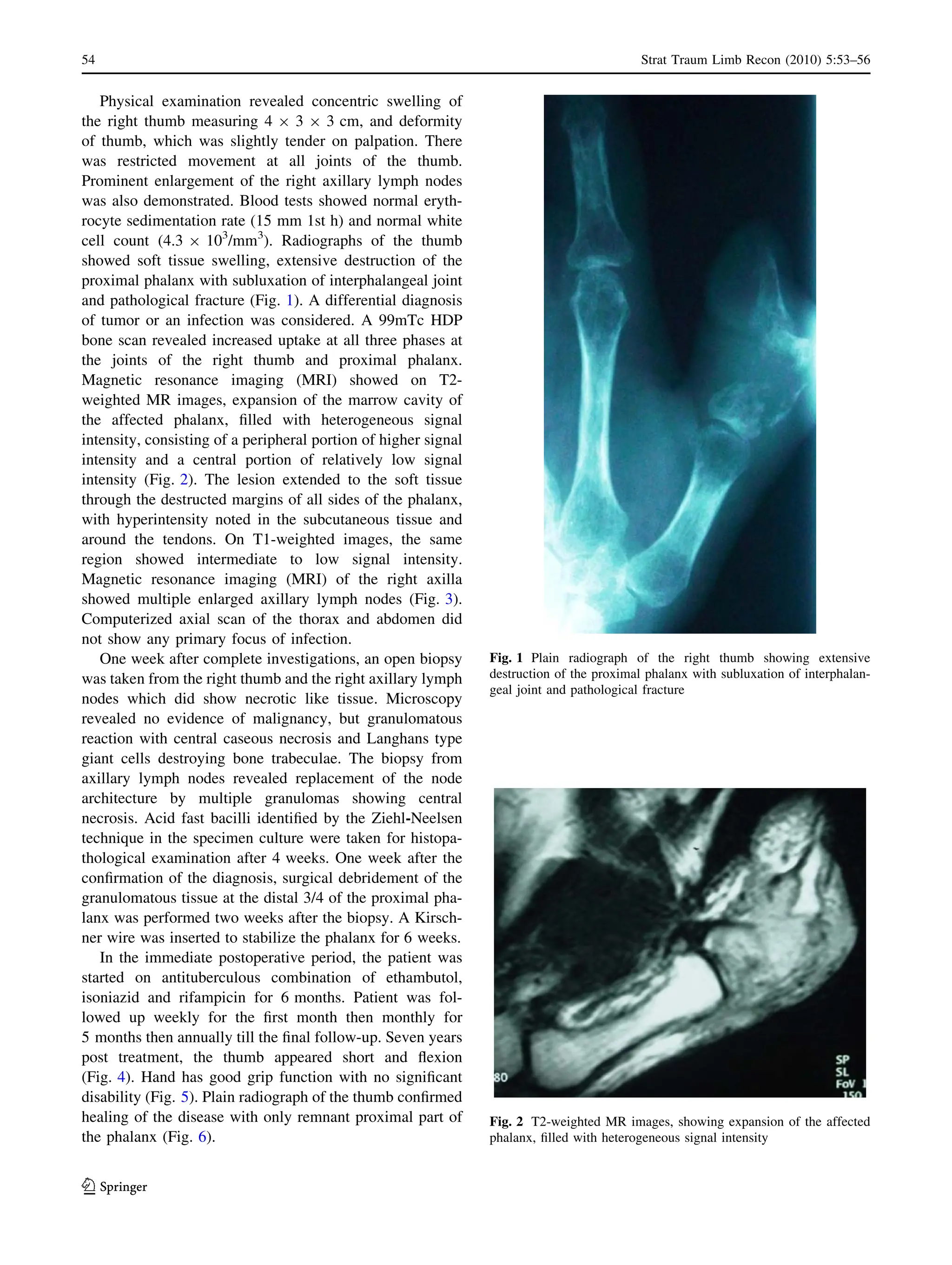 Tuberculous dactylitis pseudotumor of an adult thumb.pdf