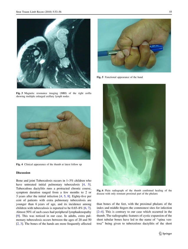 Tuberculous dactylitis pseudotumor of an adult thumb.pdf
