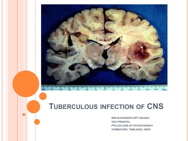 Tuberculous infection of CNS | PPTX | Brain and Nervous System ...