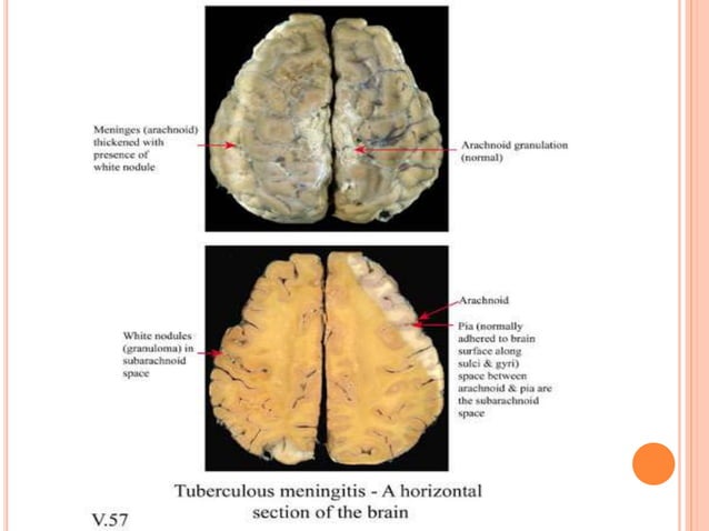 Tuberculous infection of CNS | PPTX | Brain and Nervous System ...