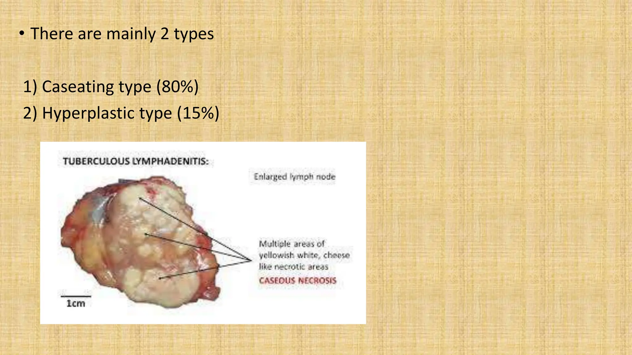 TUBERCULOUS LYMPHADENITIS.pptx