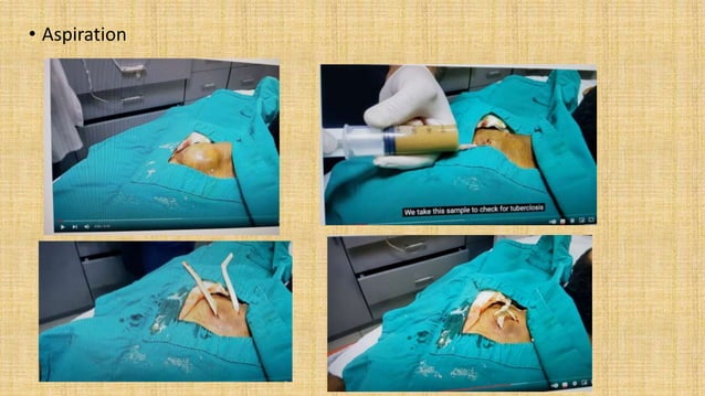 TUBERCULOUS LYMPHADENITIS.pptx | Ear, Nose and Throat Conditions ...