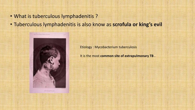 TUBERCULOUS LYMPHADENITIS.pptx | Ear, Nose and Throat Conditions ...