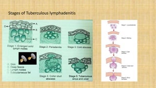 TUBERCULOUS LYMPHADENITIS.pptx