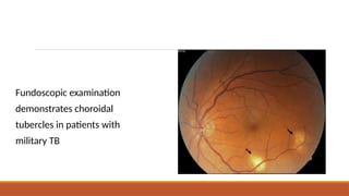 tuberculous meningitis- clinical features, management | PPTX