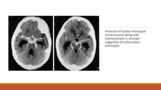 tuberculous meningitis- clinical features, management | PPTX