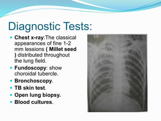 Tuberculous meningitis and miliary tb | PPTX