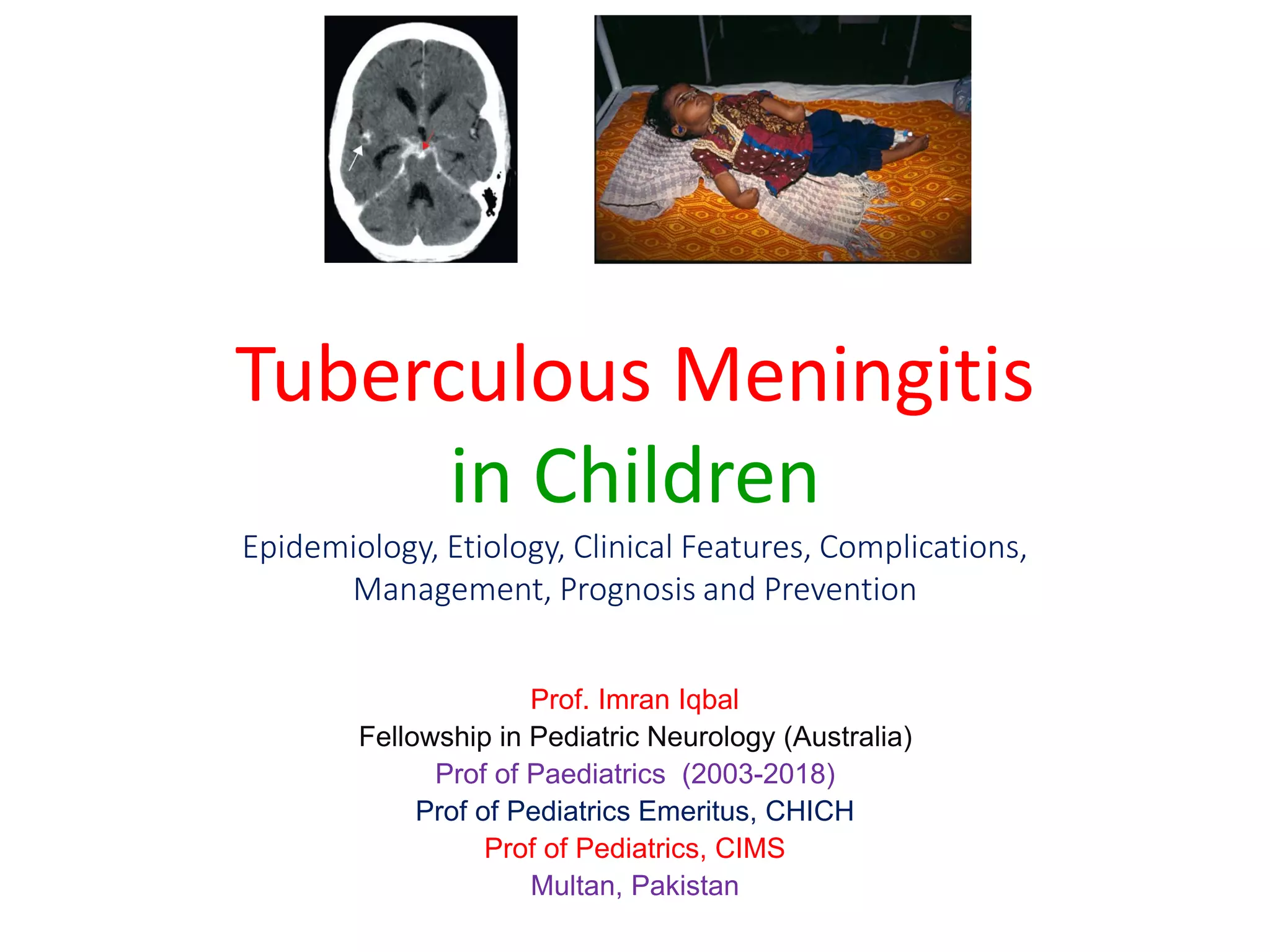 Tuberculous meningitis in children 2021 | PDF