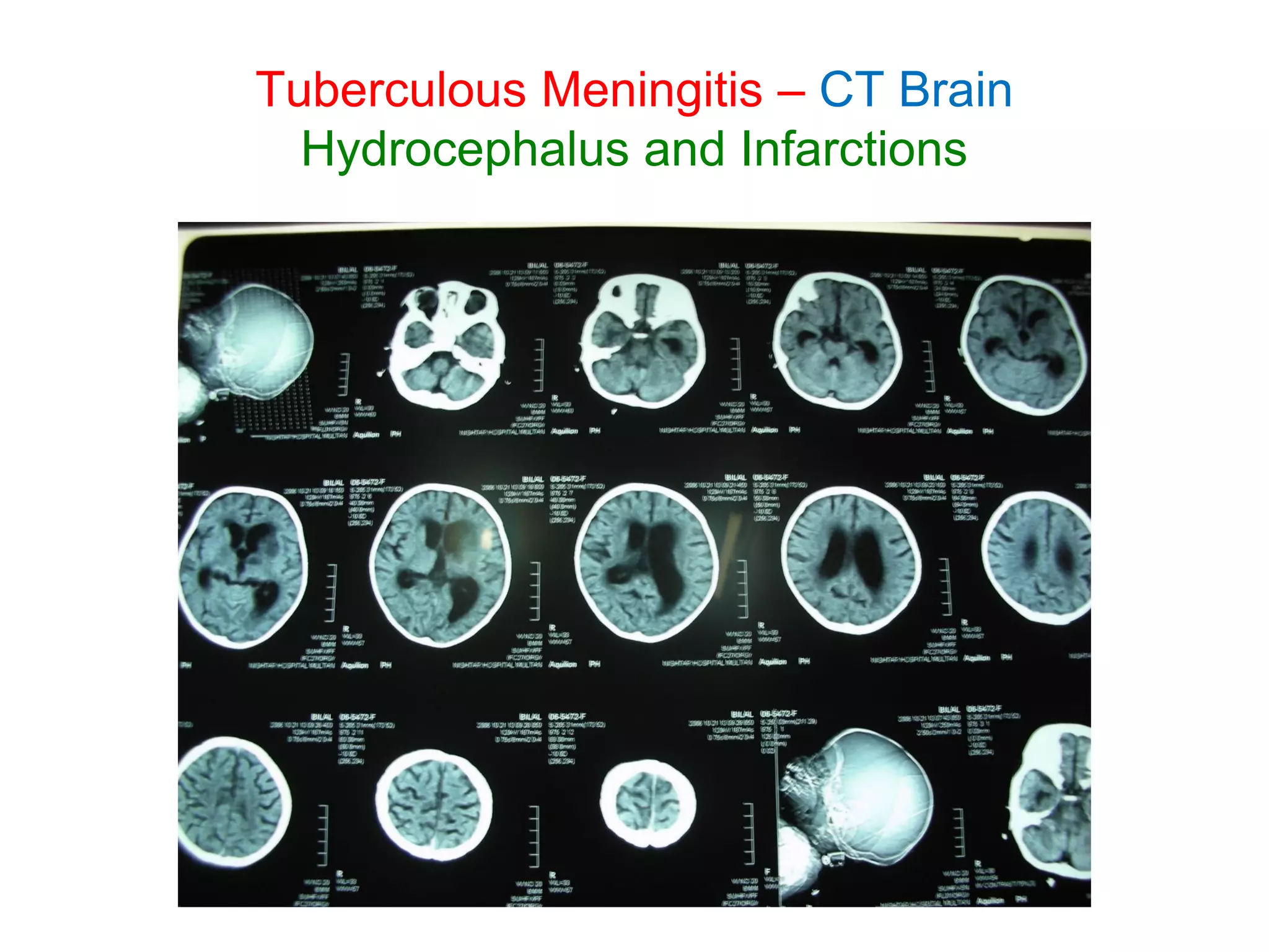 Tuberculous meningitis in children 2021 | PDF