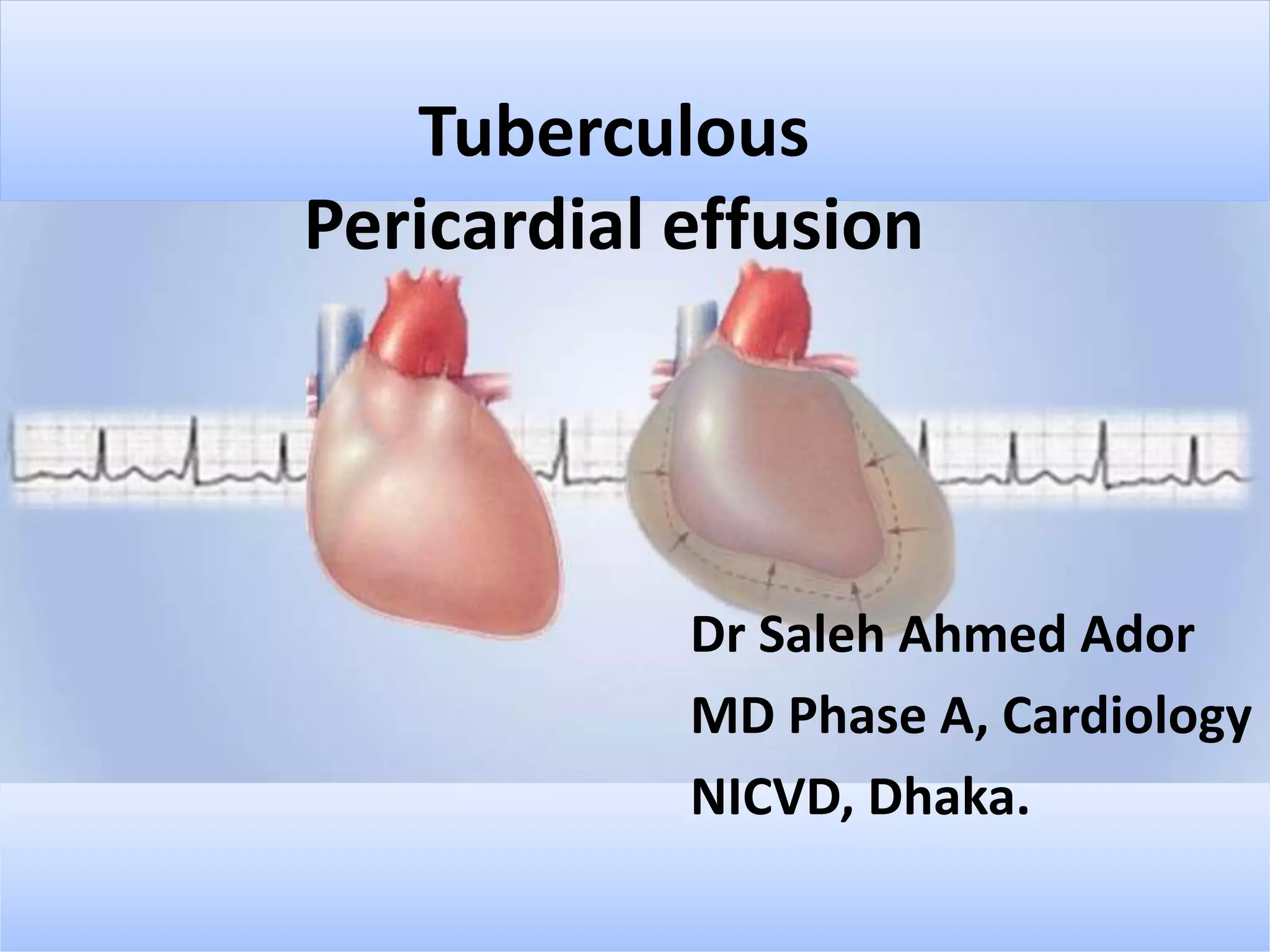 Tuberculous pericardial effusion | PPTX