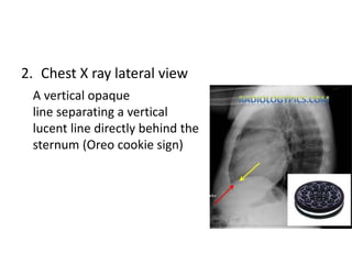 Tuberculous pericardial effusion | PPTX