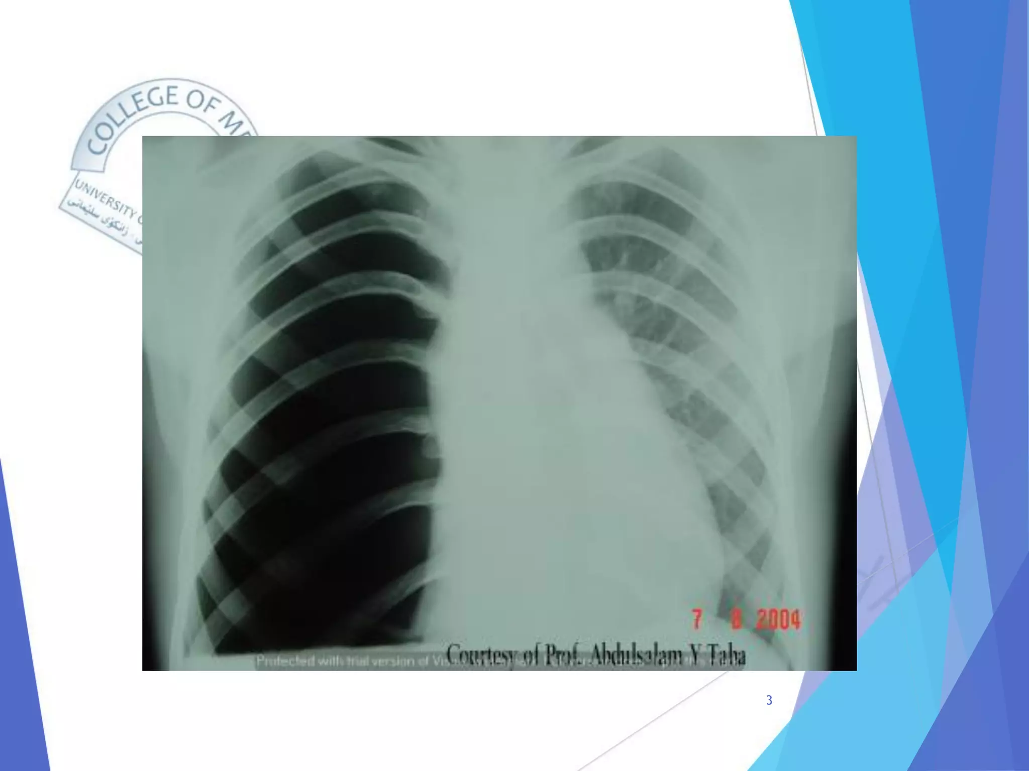 Tuberculous Pneumothorax.pdf