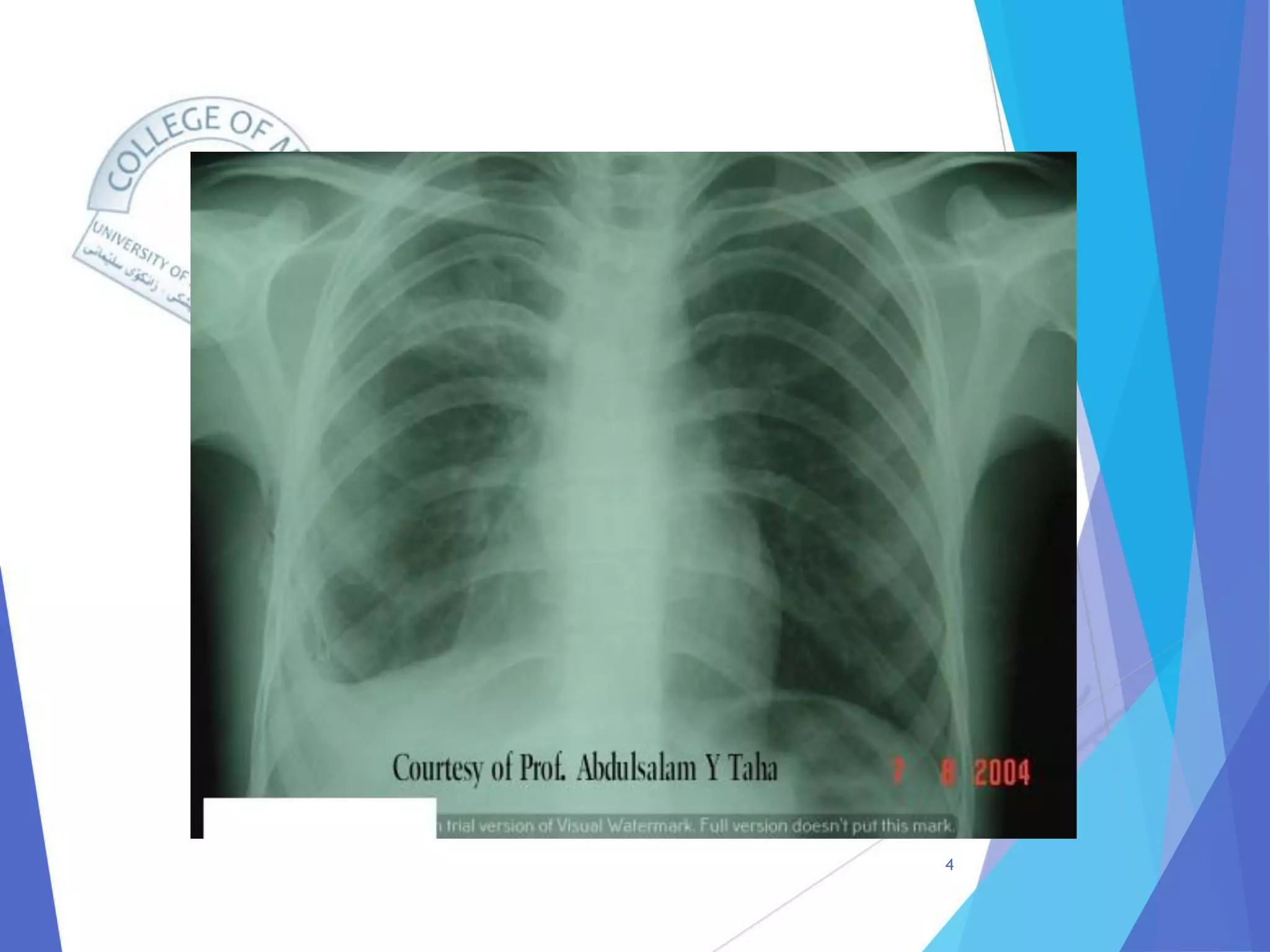 Tuberculous Pneumothorax.pdf