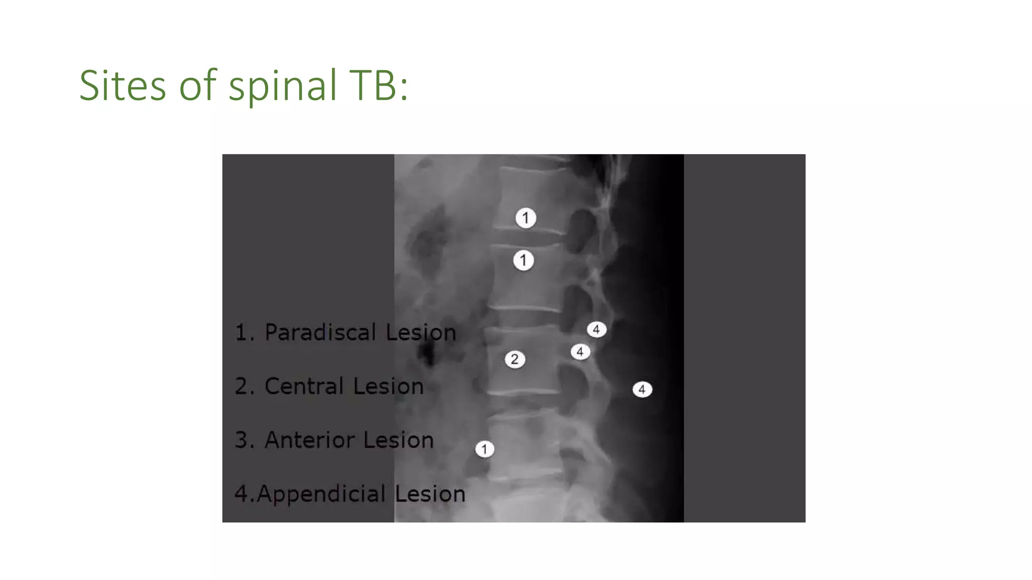 Tuberculous spondylodiscitis.pptx