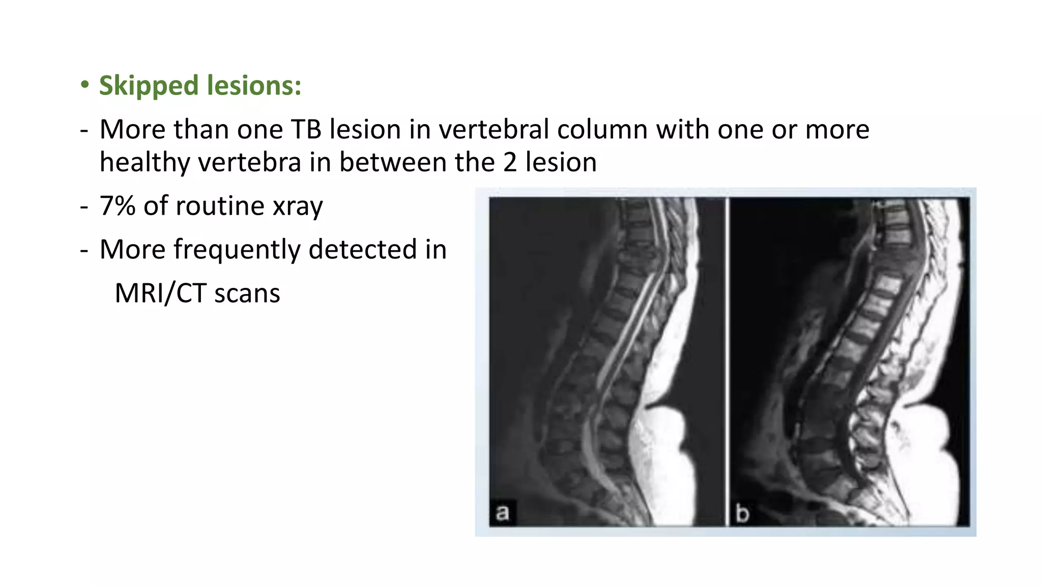 Tuberculous spondylodiscitis.pptx