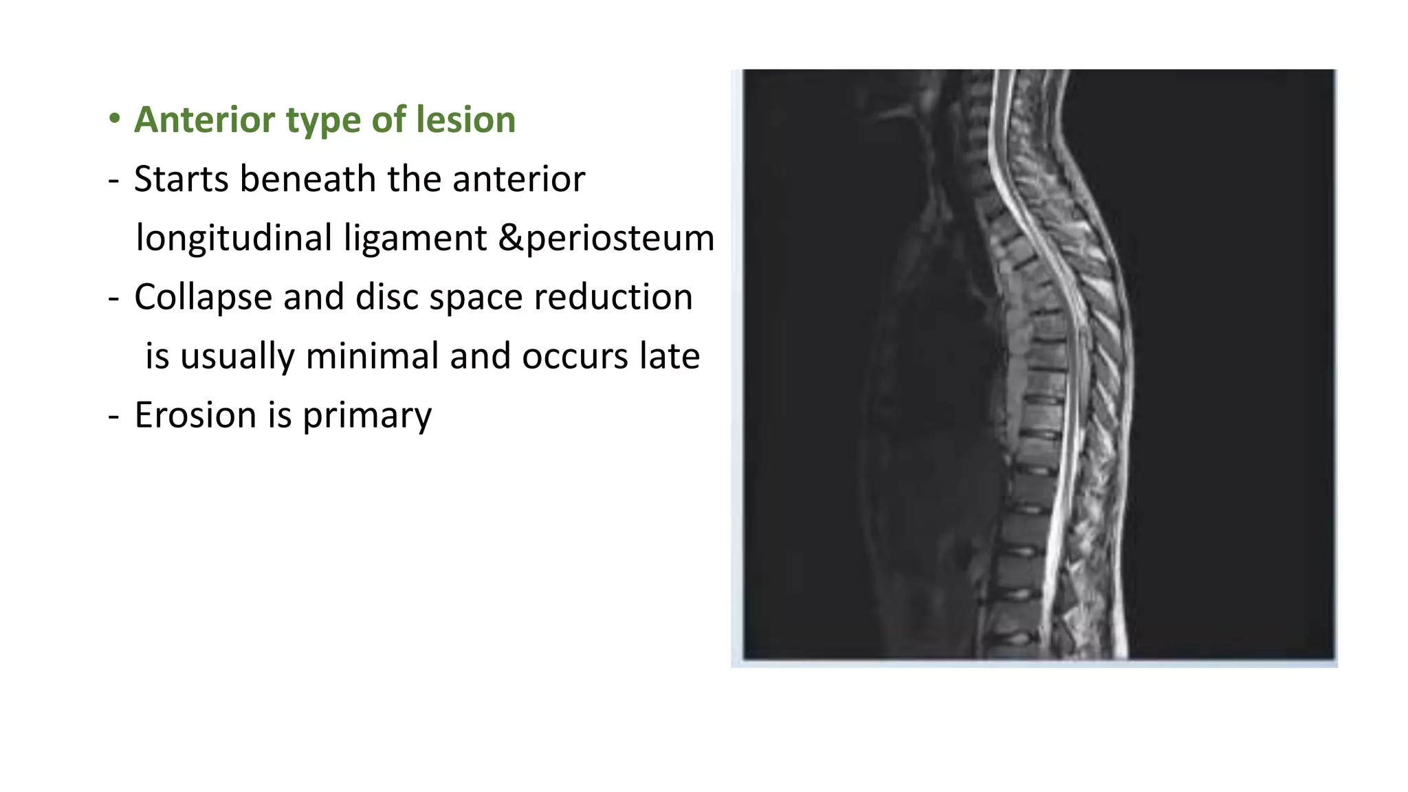 Tuberculous spondylodiscitis.pptx