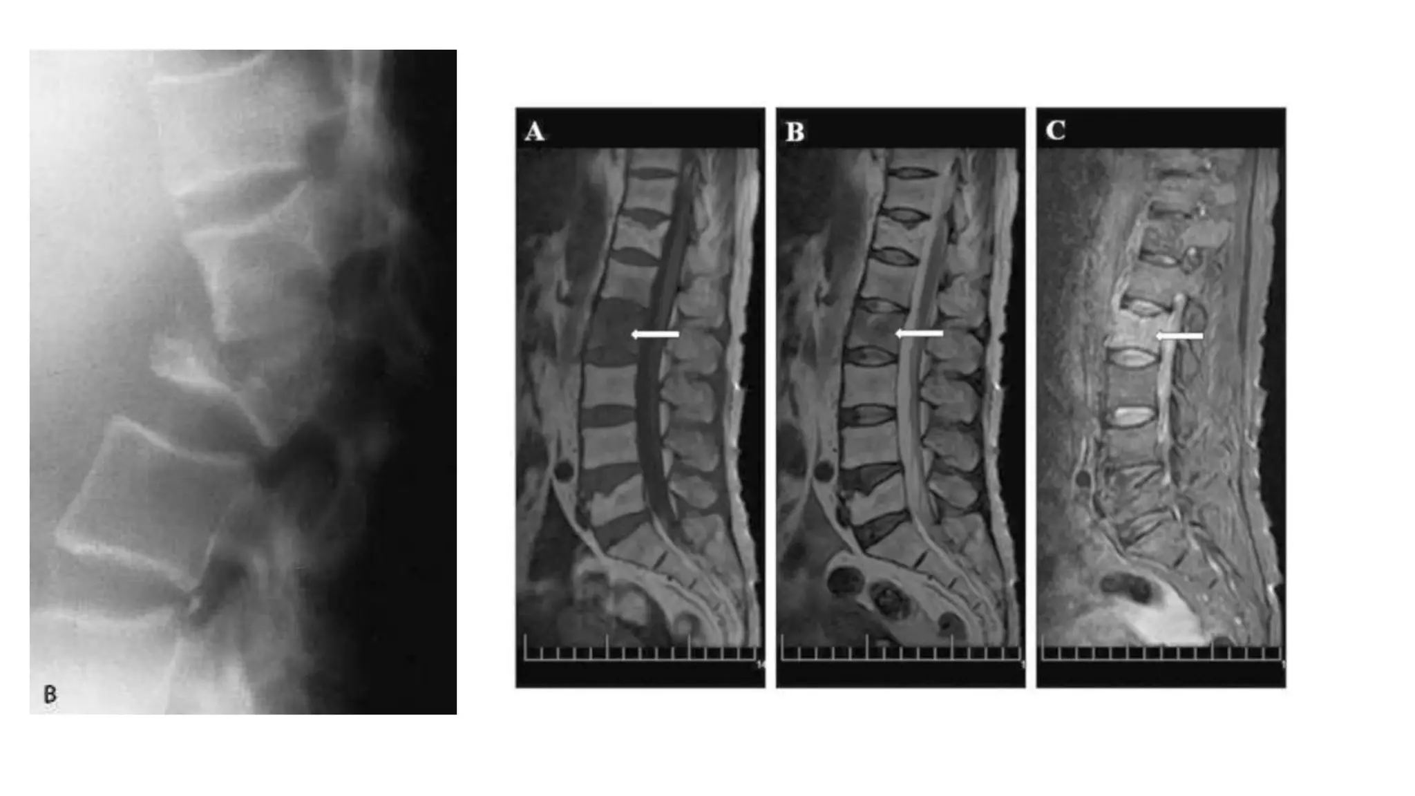 Tuberculous spondylodiscitis.pptx