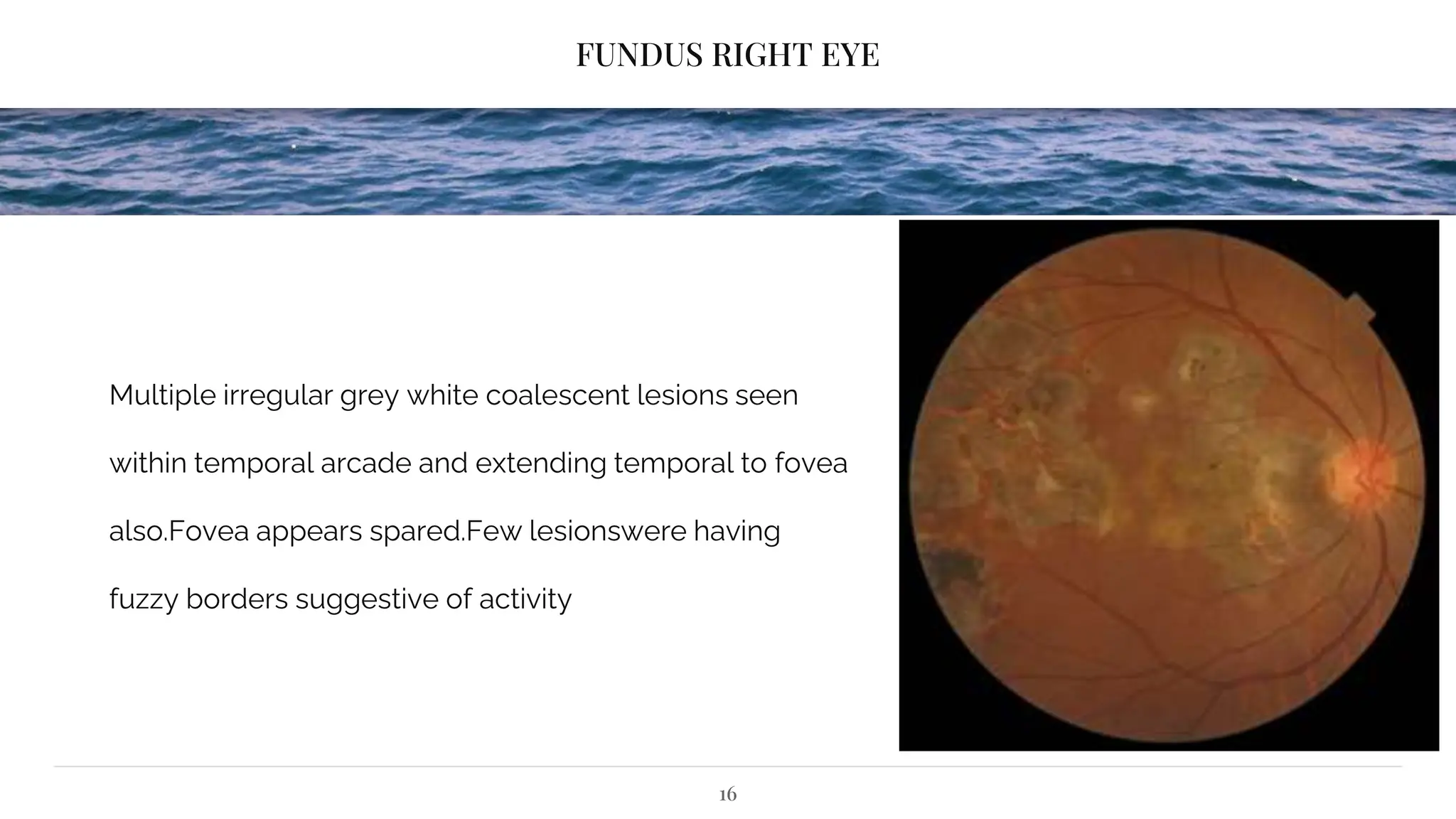 Tuberculous uveitis.pptx for educational purpose only | PPT