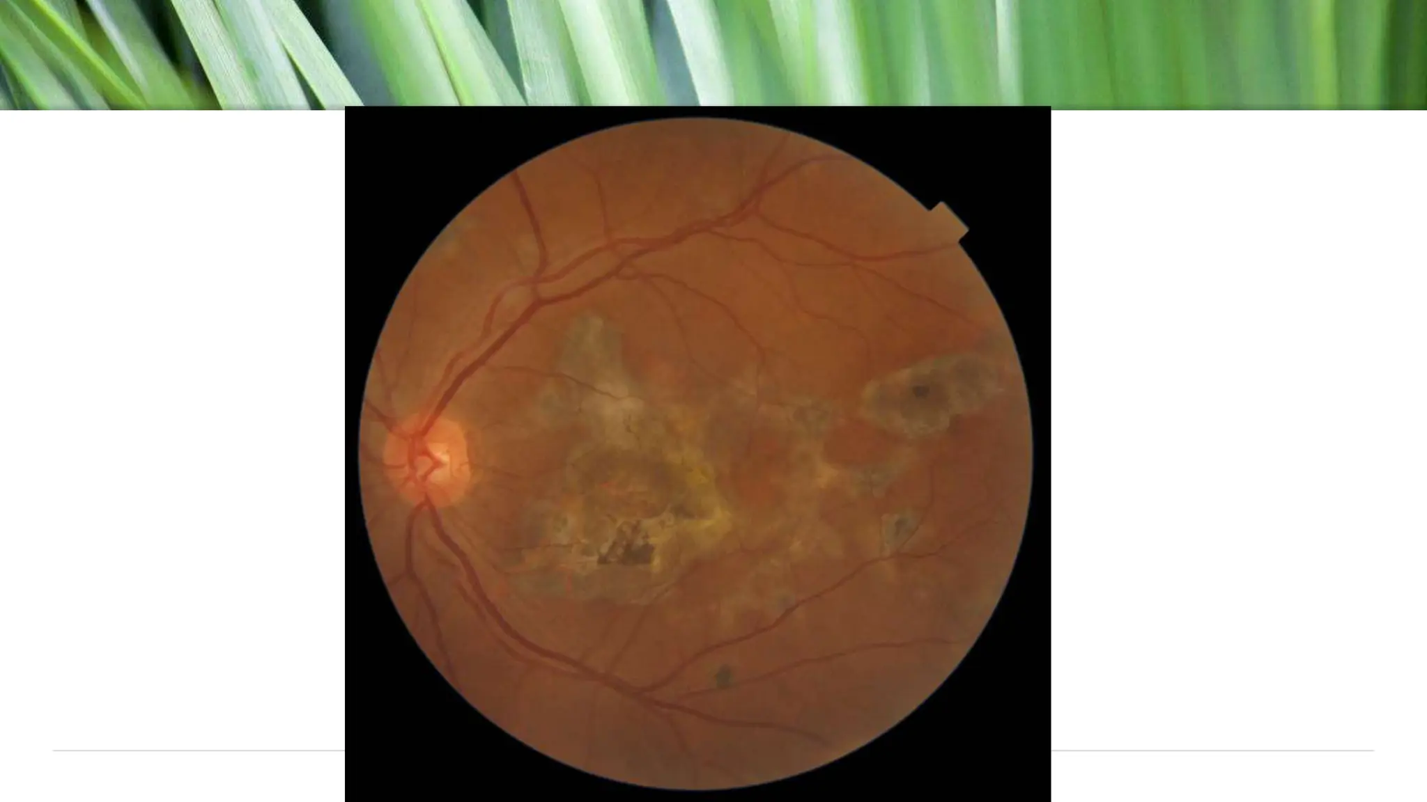 Tuberculous Uveitis Pptx For Educational Purpose Only Ppt