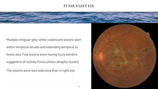 Tuberculous uveitis.pptx for educational purpose only | PPT