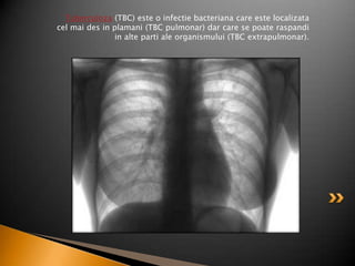 Tuberculoza | PPTX
