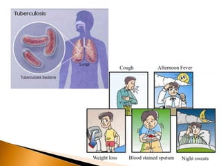 Tuberculoza | PPTX