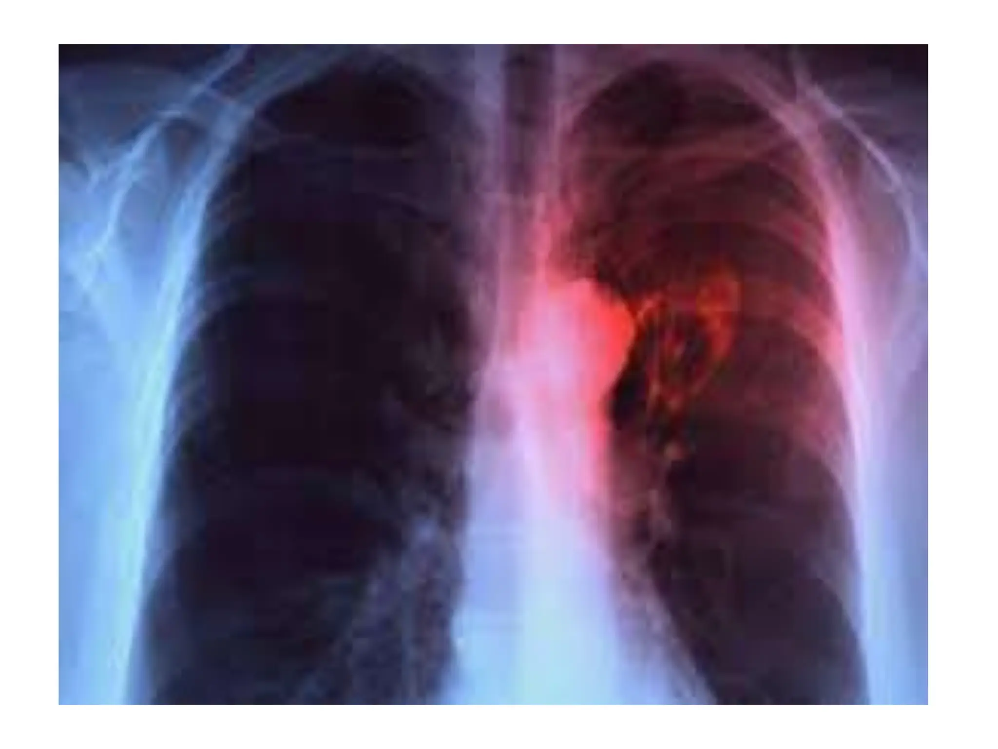 bolo all eplamanilor produse de bacterii-tuberculoza.pptx