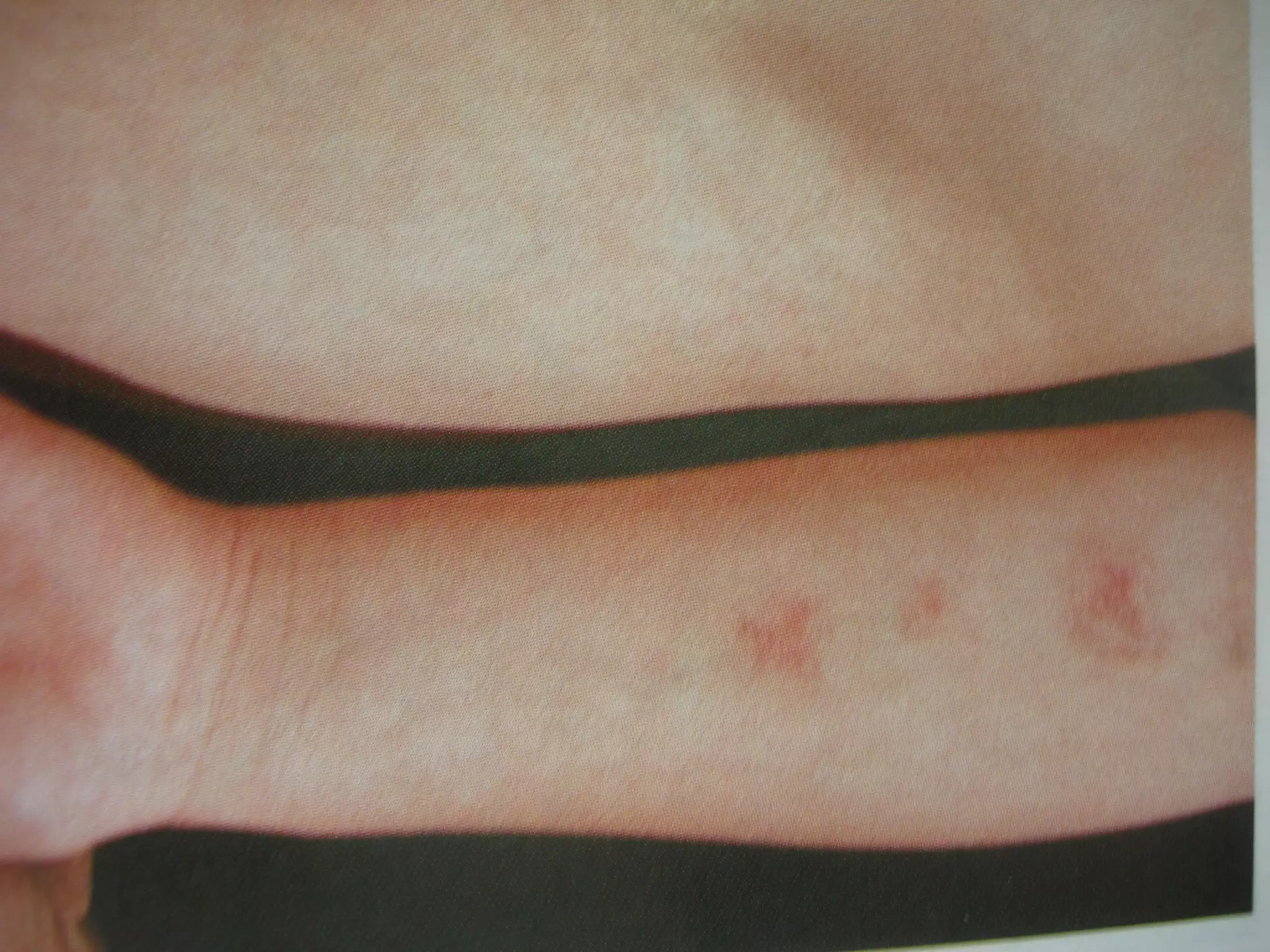 Tuberkulosis kutis | PPT