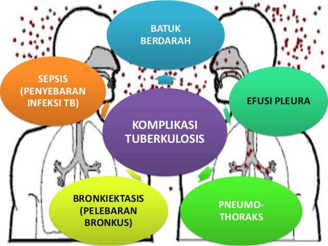 Tuberkulosis paru kapevi