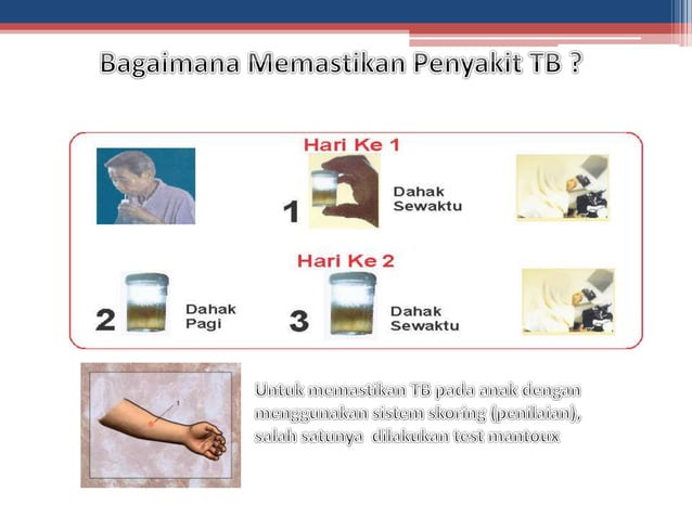 Tuberkulosis Pkm Sempu.pptx