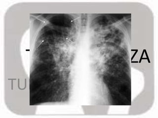Tuberkuloza-Tuberculosis | PPTX