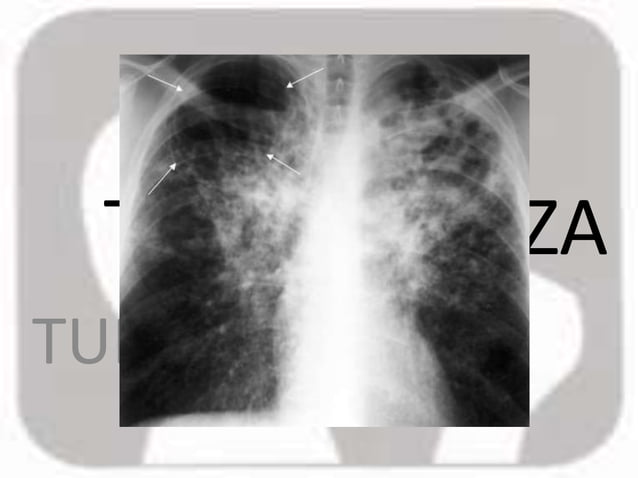 Tuberkuloza-Tuberculosis | PPTX