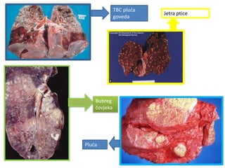 Tuberkuloza-Tuberculosis | PPTX