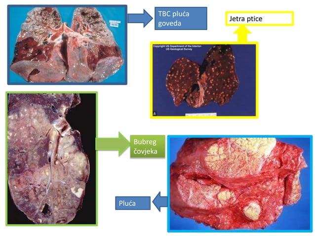 Tuberkuloza-Tuberculosis | PPTX