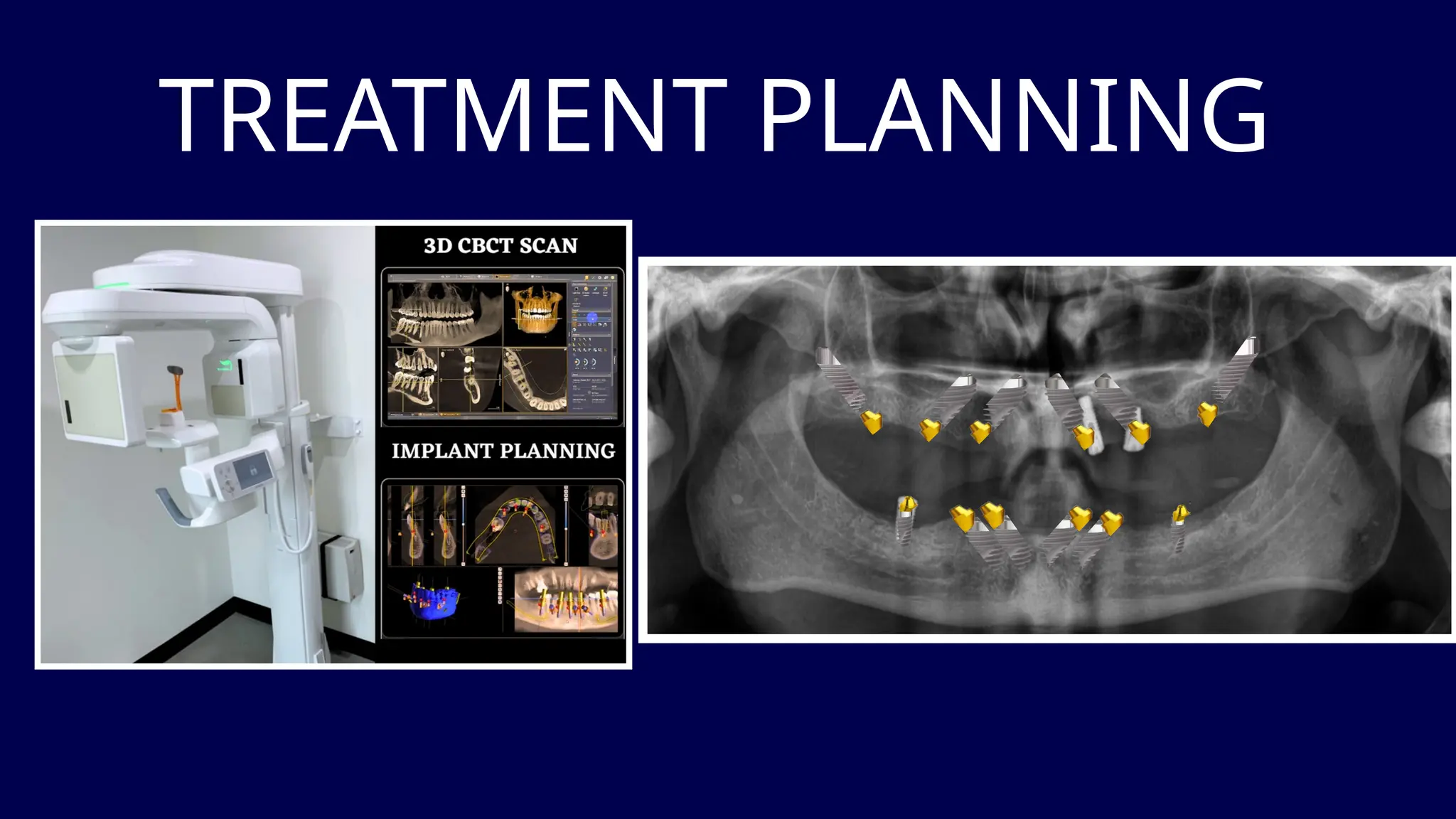 TUBERO PTERYGOID IMPLANTS | DR K A REDDY | LBR DENTAL | PPTX