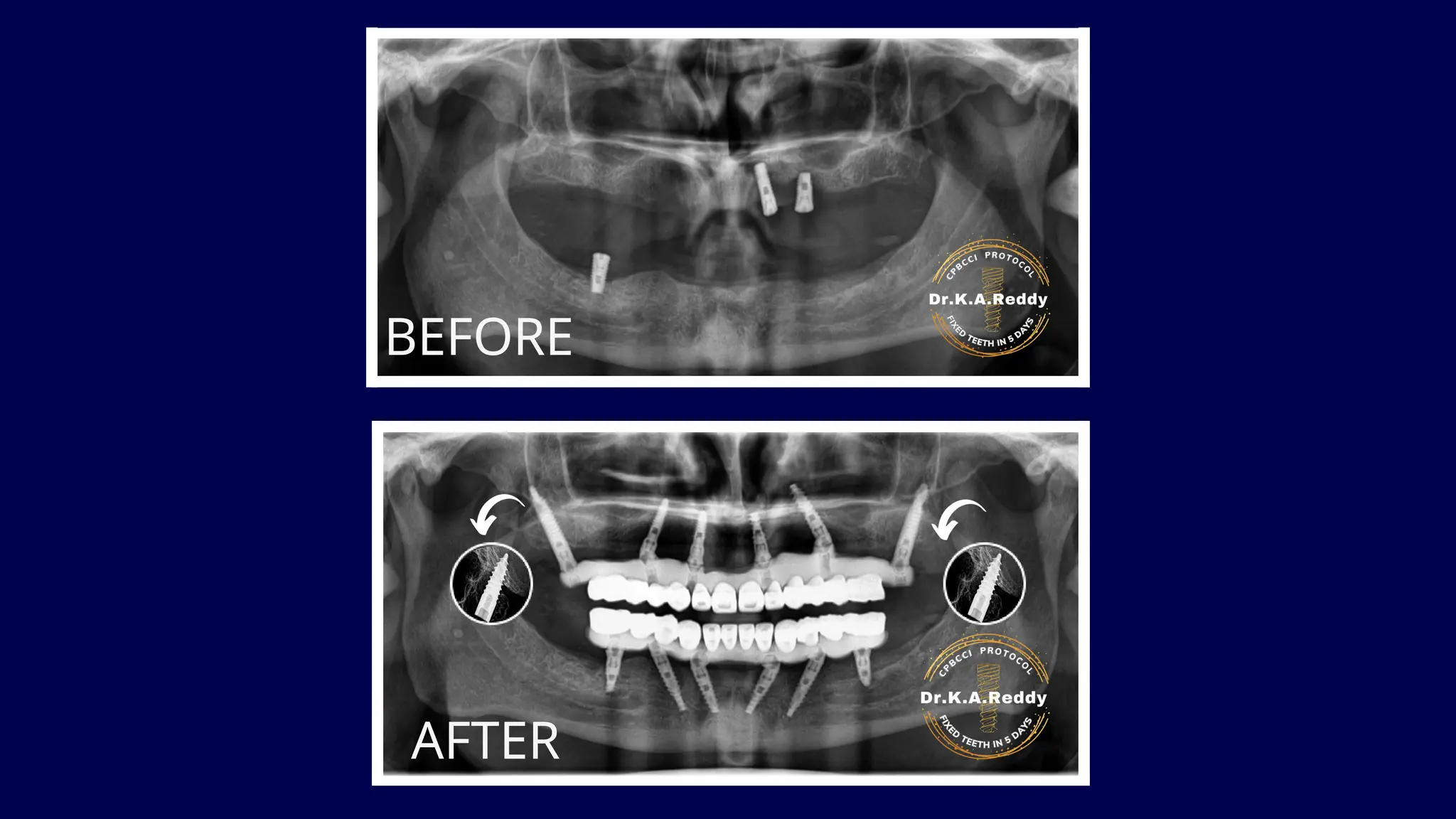 TUBERO PTERYGOID IMPLANTS | DR K A REDDY | LBR DENTAL | PPTX