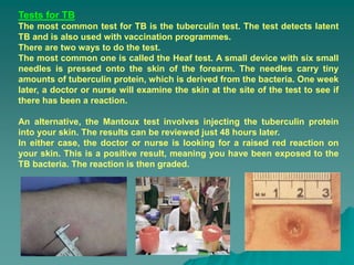 Tuberosis presentation1 | PPSX | Lung and Respiratory Health | Diseases ...